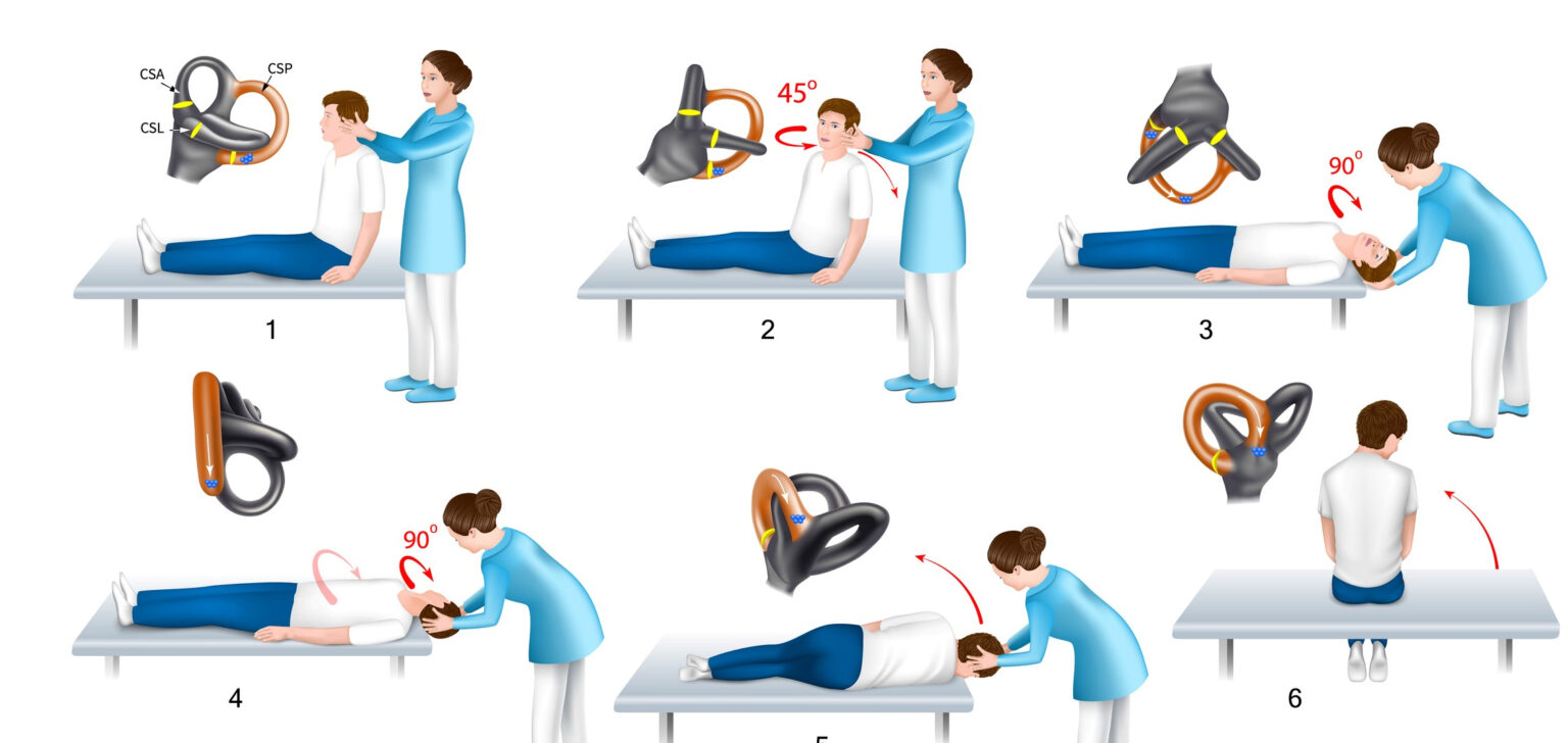 Abordaje terapéutico no farmacológico del vértigo posicional ...